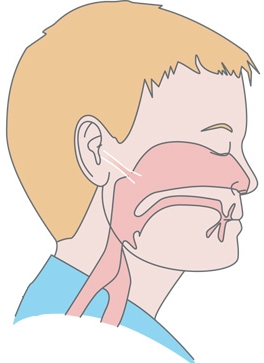 Slijmoor (Otitis media met effusie)